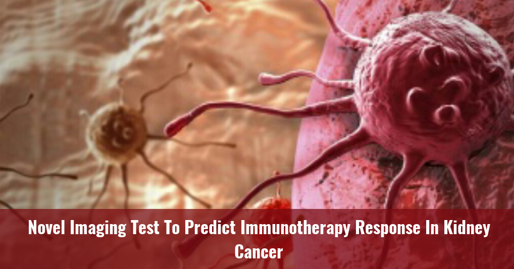 Novel imaging test to predict immunotherapy response in kidney cancer ...